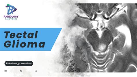 Tectal Glioma Youtube