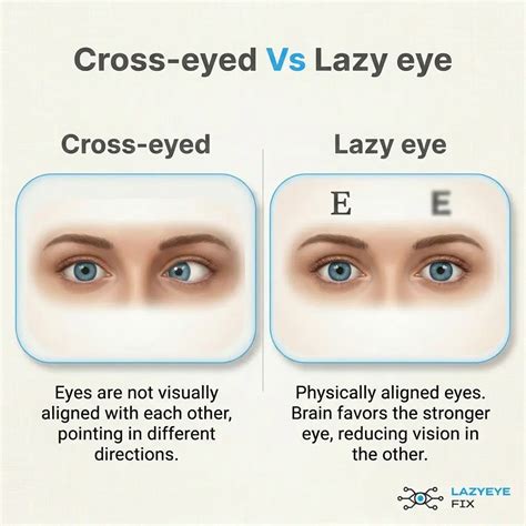 Cross Eyed Vs Lazy Eye Lazyeyefix