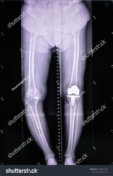 Xray Scanogram Youtube Scanogram Both Lower Limb🏥 Xray Doctor