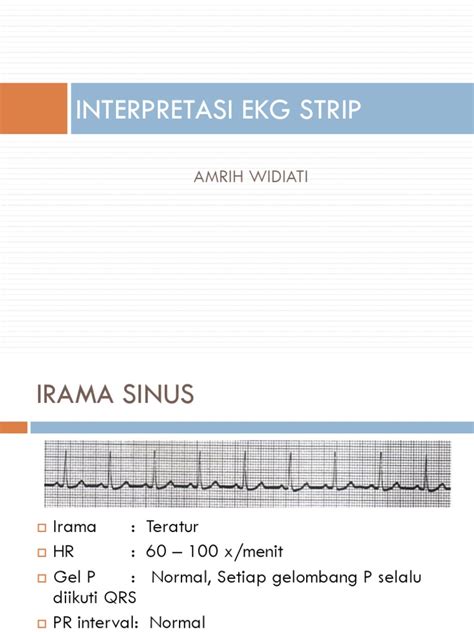 Ekg Lethal