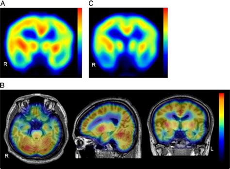 Persistent Déjà Vu Associated With Hyperperfusion In The Entorhinal