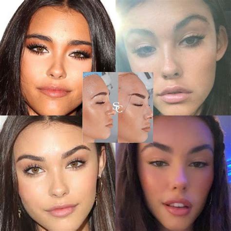Madison Beer Eyebrow Liftfoxy Eye Surgery Eyebrow Lift Cheek