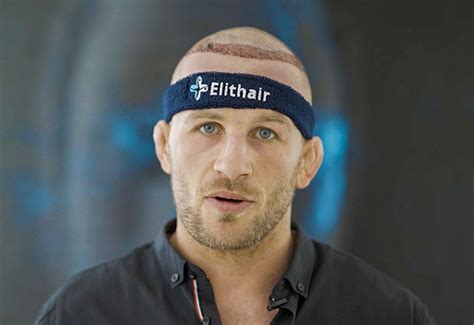 Stephan Pütz Fotografias Antes E Depois 5700 Enxertos Elithair