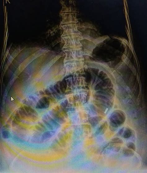 Dilated Bowel Loops X Ray At Clinton Long Blog