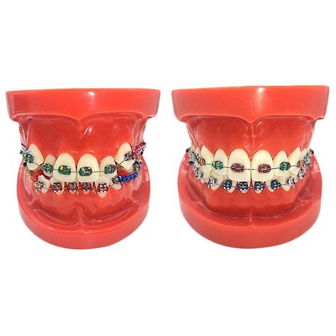 Buy Dental Typodont With Mental Brackets Orthodontic Teeth Model With