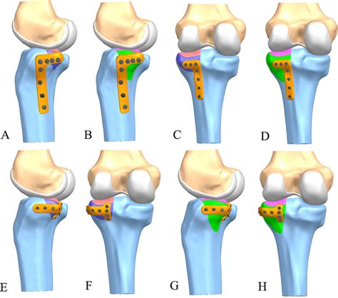 A The Modeling Diagram Of Alp A 35 Mm Proximal Tibia Locking