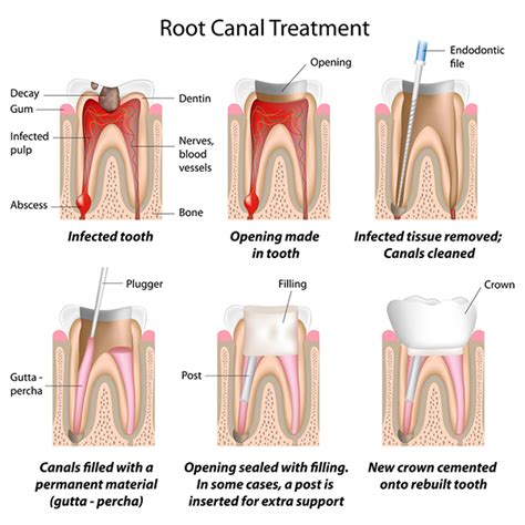 My Tooth Is Dead Hoyt Dental Murrieta And Temecula Dentist