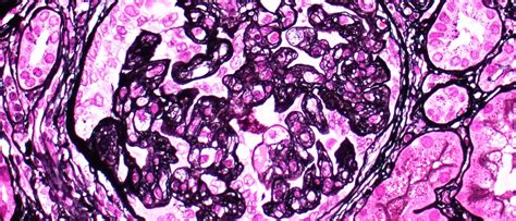 Renal Pathology University Of Iowa Diagnostic Laboratories Uidl