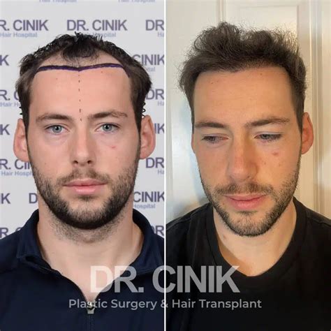 Evolución Del Injerto Capilar Mes A Mes Dr Cinik