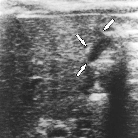 Sonographic Diagnosis Of Biliary Atresia In Pediatric Patients Using