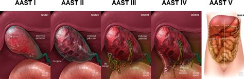Table 2 From Validation Of The Aast Egs Acute Cholecystitis Grade And Comparison With The Tokyo