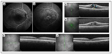 Twelve Months Outcomes And Optical Coherence Tomography Oct