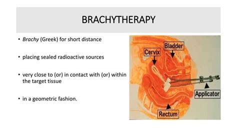 Brachytherapy In Carcinoma Cervix History To Present Pptx Medical