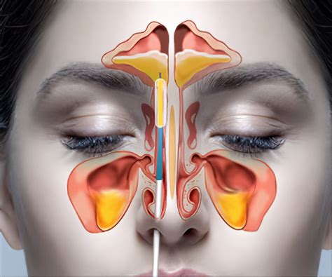 Sinus Surgery Facts Preparation Operative Procedure Recovery