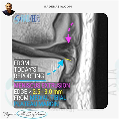 A Few Mri Meniscus Abnormalities 2 Mri Meniscus Degeneration Maceration Flap Tear Extrusion And