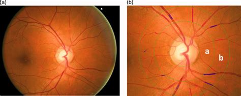 A Stereoscopic 45° Color Retinal Photograph Centered On The Optic Download Scientific