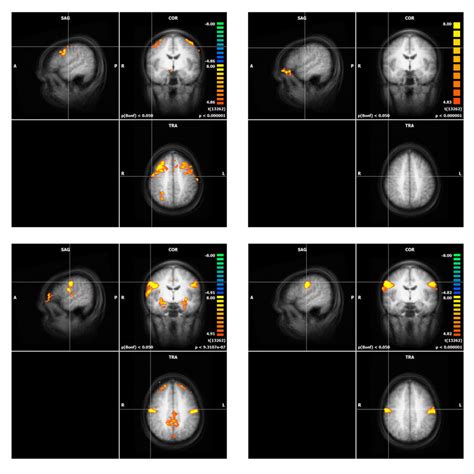 Whole Brain Analysis Of Differential Mapping Glm In Conjunction With Download Scientific