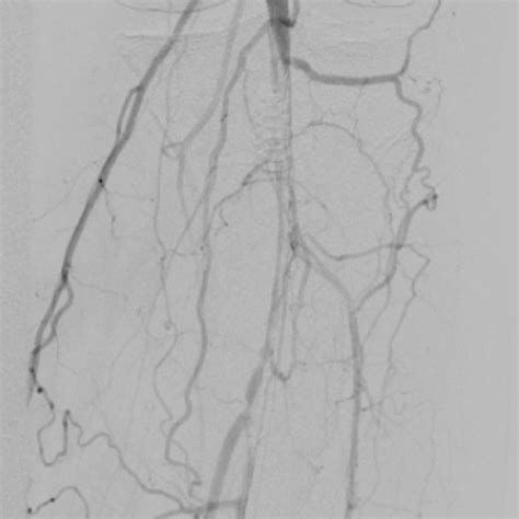 Pdf Ip179 Delayed Tibioperoneal Trunk Aneurysm After Atherectomy And
