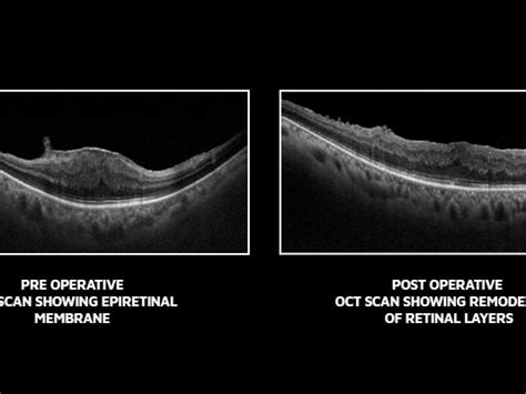 Vitrectomy Membrane Peeling