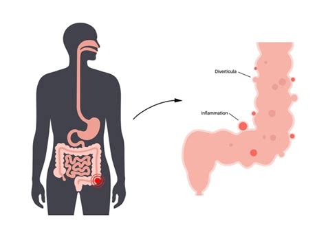 314 Digestive System Bleeding Vector Stock Vectors And Vector Art