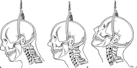 Cervical Facet Dislocations And Fractures Spine Orthobullets