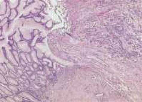 A Stomach Ulcer With Epithelioid Gist 50x Hematoxylin And Eosin