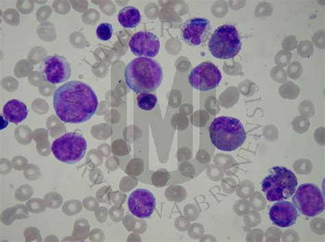 Telehematology Aml M4 Eo Bm