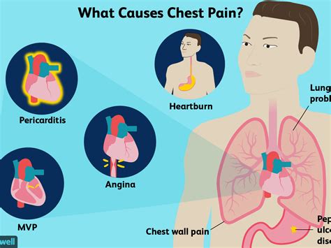 How To Relieve Chest Soreness Intelligencesupply16