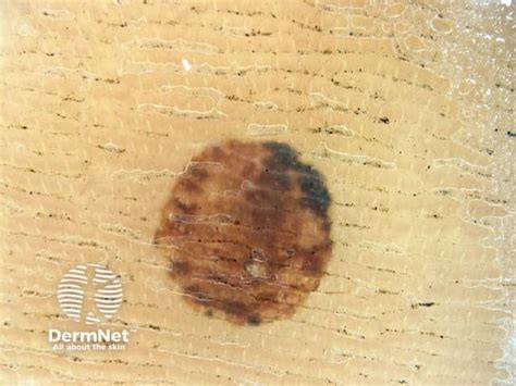 Dermoscopy Pattern Analysis