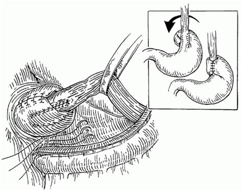 Repair Of Paraesophageal Hernia Thoracic Key