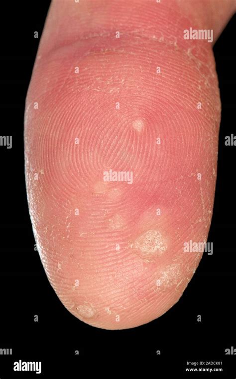 Common Warts Verruca Vulgaris On The Finger Of A Year Old Male Patient Warts Are Harmless