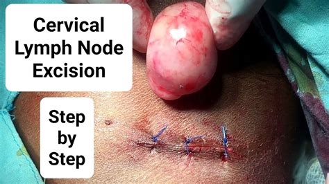 Cervical Lymph Node Excision Biopsy Step By Step Dr Tayyab Riaz Ch