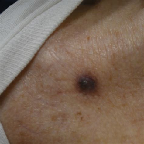 Cutaneous Metastasis Of An Undiagnosed Prostatic Adenocarcinoma Mdedge