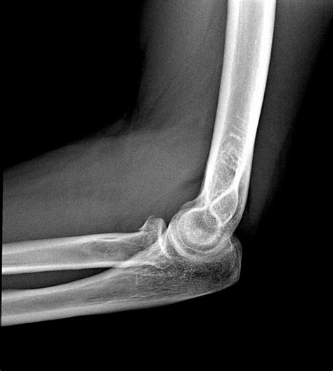 Mason Classification Of Radial Head Fractures Pacs