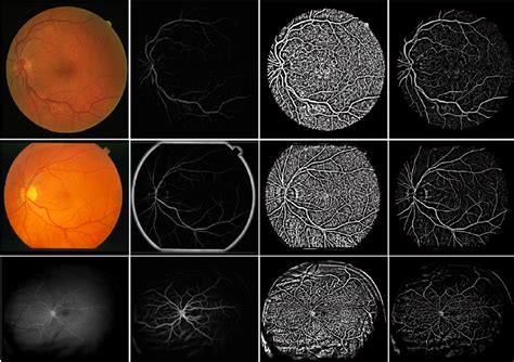 Enhancement Results Produced By The Eigenvalue Based Method [2] Download Scientific Diagram