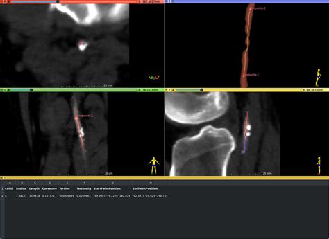 Vmtk Centreline And Metrics Support 3d Slicer Community
