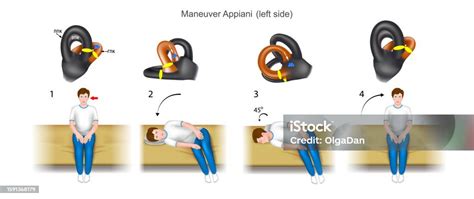 Appiani Maneuver Left Side Stock Illustration Download Image Now