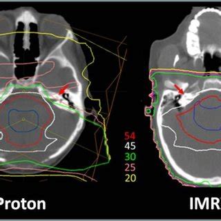 Proton Radiotherapy Dosimetry A Representative Plan Is Shown Depicting Download Scientific