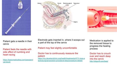 What Is The Cpt Code For Leep Procedure