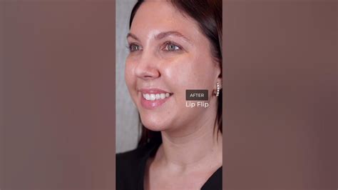 Lip Flip Before And After Dr Paul Nassif Youtube