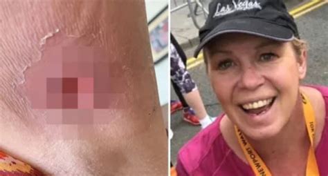 Spider Bite Leaves Woman With Hole In Armpit Newsam Medicine All