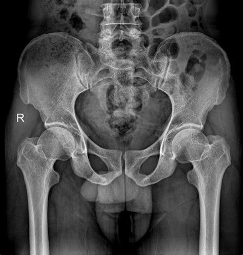 3 Imágenes Fotos De Stock Objetos En 3d Y Vectores Sobre Ap Pelvis