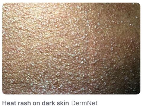 Heat Rash Vs Eczema Whats The Difference — Uptown Dermatology