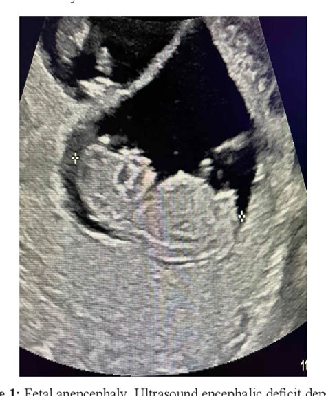 Figure 1 From Dichorionic Diamnionic Twin Pregnancy Discordant For Anencephalya Case Report And