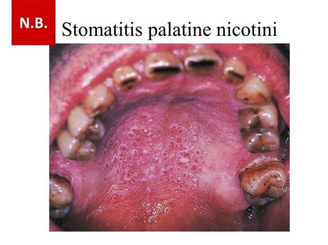 Precancerous Lesions In Oral Cavity Pdf