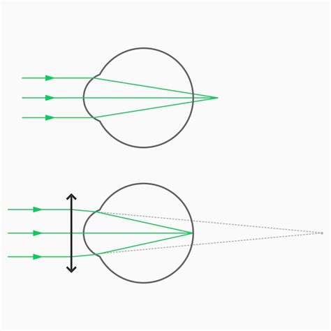 Premium Vector Hyperopia Hypermetropia Farsightedness And Hyperopia Correction With Glasses