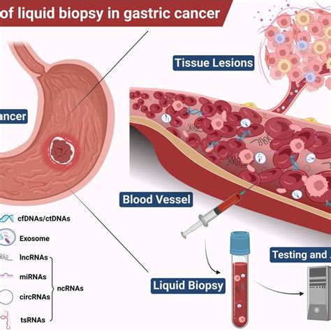 Clinical Application Of Liquid Biopsy In Gastric Cancer Gc Download Scientific Diagram