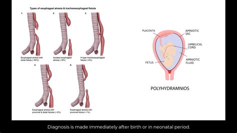 Tracheoesophageal Fistula Classification