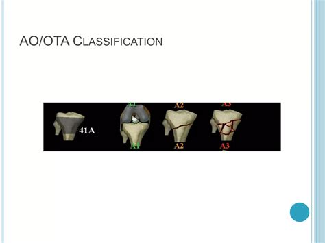 Proximal Tibia Fracture Ppt