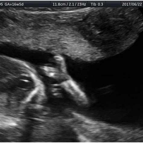 Pdf Prenatal Diagnosis Of Ectrodactyly Ectodermal Dysplasia Clefting Syndrome ‒ A Case Report